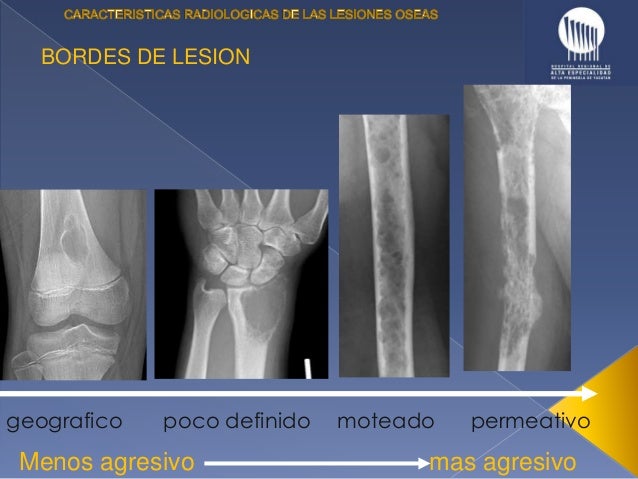 Caracteristicas Radiologicas De Las Lesiones Oseas