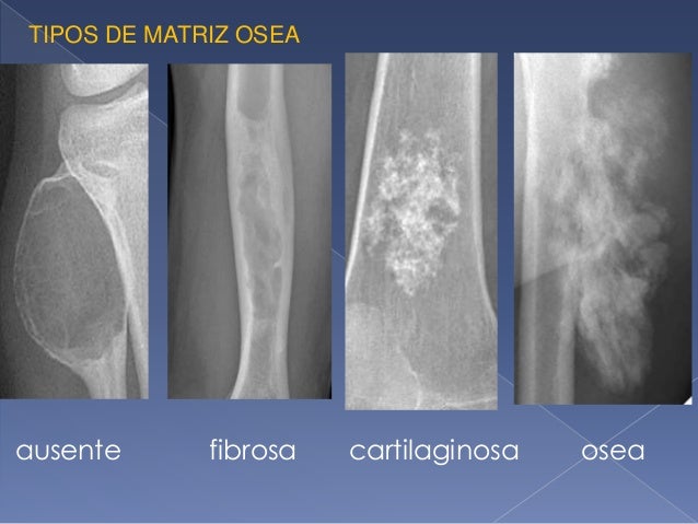 Caracteristicas Radiologicas de las Lesiones Oseas