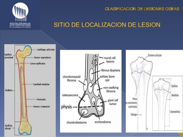 Caracteristicas Radiologicas de las Lesiones Oseas