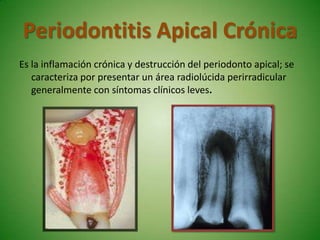 Lesiones periapicales | PPTX