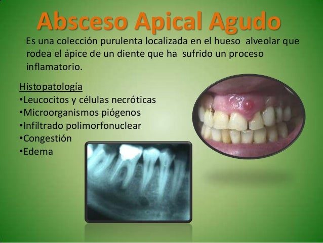 Lesiones periapicales