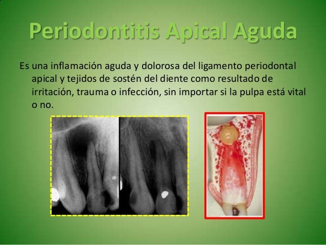 Lesiones periapicales