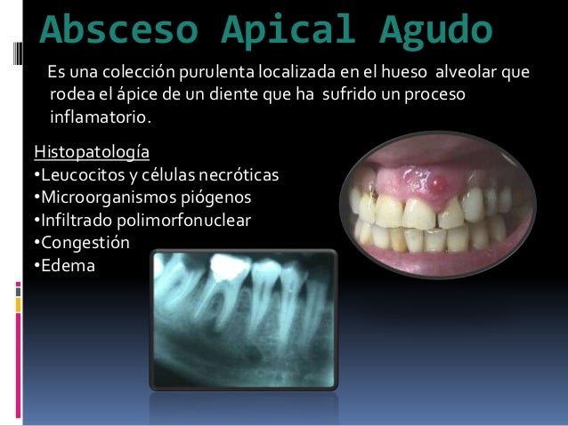 Lesiones periapicales