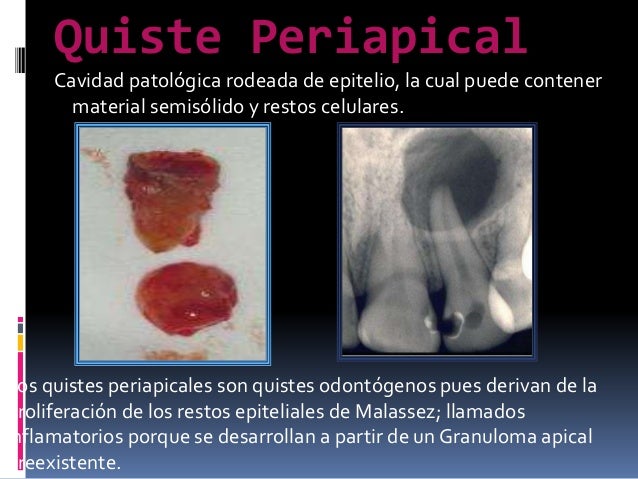 Lesiones periapicales