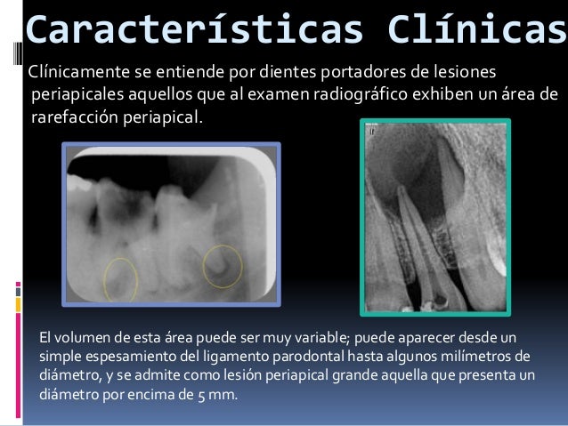 Lesiones periapicales