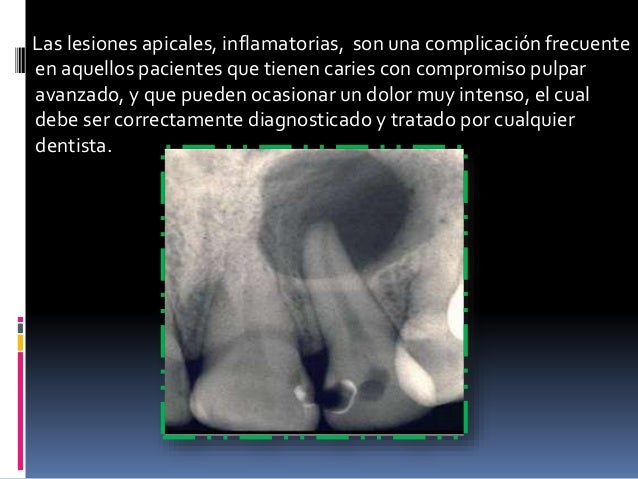 Lesiones periapicales