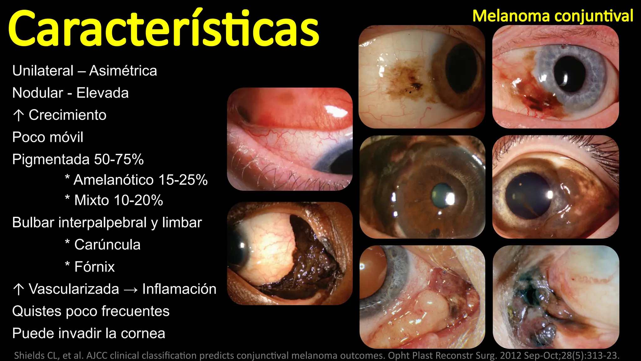 Lesiones pigmentadas de la conjuntiva - Melanoma, PAM, Nevus....pptx