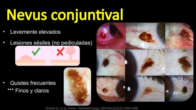 Lesiones pigmentadas de la conjuntiva - Melanoma, PAM, Nevus....pptx
