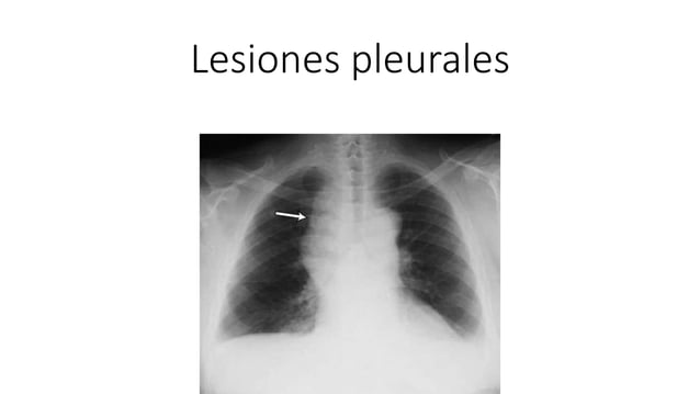 Lesiones pleurales: causas, síntomas y tratamiento | PPT