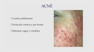 LESIONES POR ACNE descripcion, generalidades | PPTX