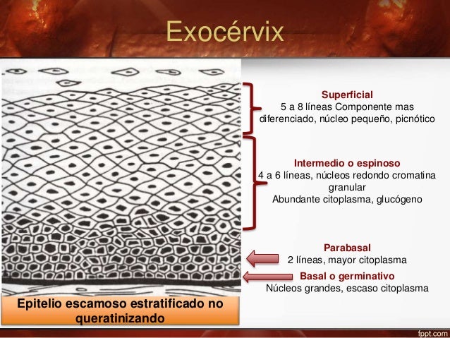 Lesiones preinvasoras del cervix