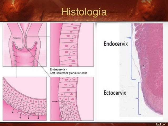 Lesiones preinvasoras del cervix