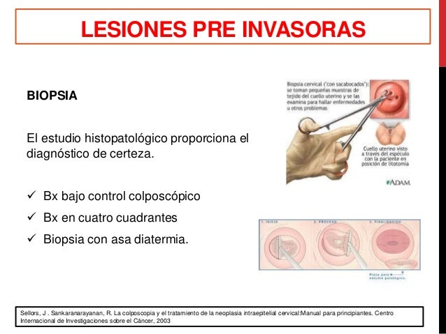 Lesiones preinvasoras y ca de cuello uterino ULA