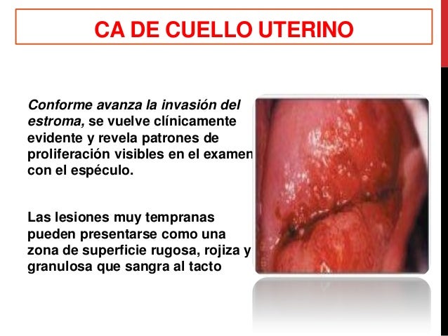 Lesiones preinvasoras y ca de cuello uterino ULA