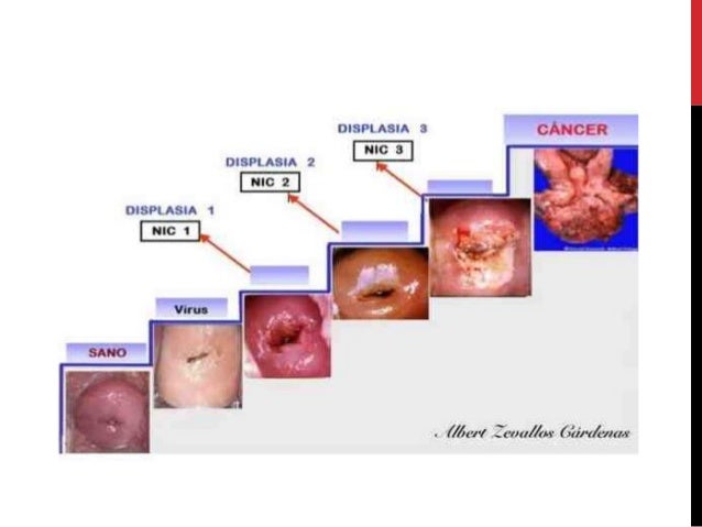 Lesiones preinvasoras y ca de cuello uterino ULA