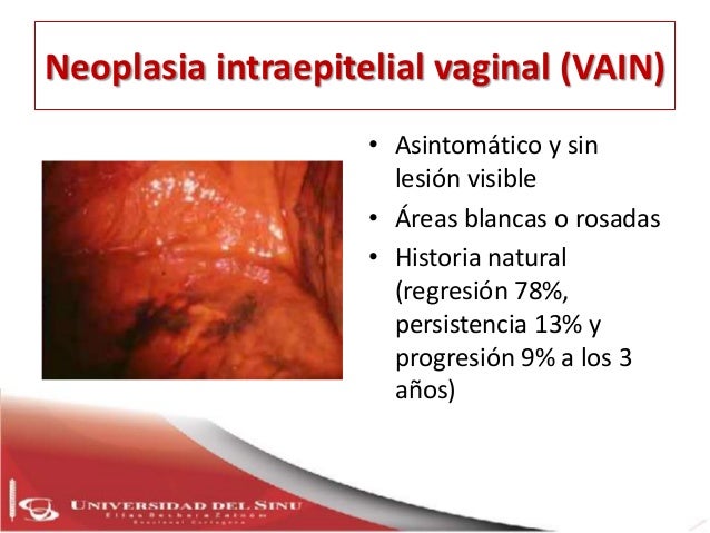 Lesiones premalignas de vulva y vagina