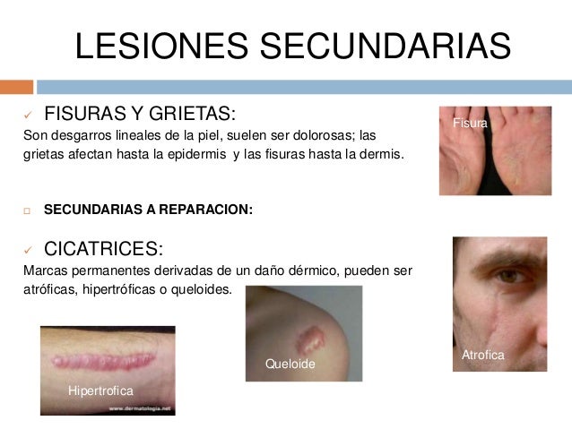 Lesiones primarias de la piel
