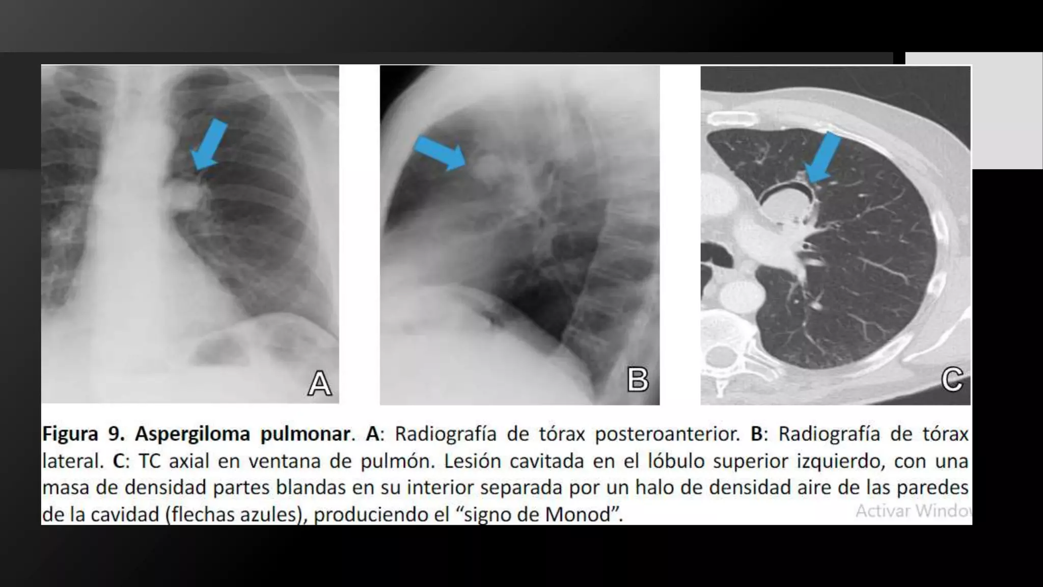 LESIONES PULMONARES CAVITADAS.pptx