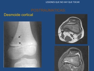 Lesiones Oseas Que No Se Deben Tocar | PPT