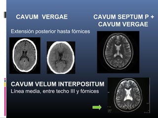 Lesiones quísticas no neoplásicas cerebrales | PPT