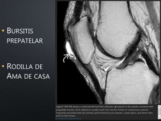 Lesiones quísticas y bursitis de rodilla | PPTX