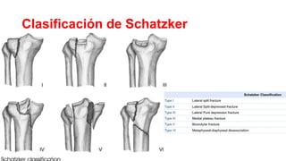 Lesiones schatzker vi | PPTX