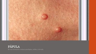Lesiones cutáneas | PPTX