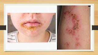 Lesiones secundarias de la piel-dermatología | PPTX