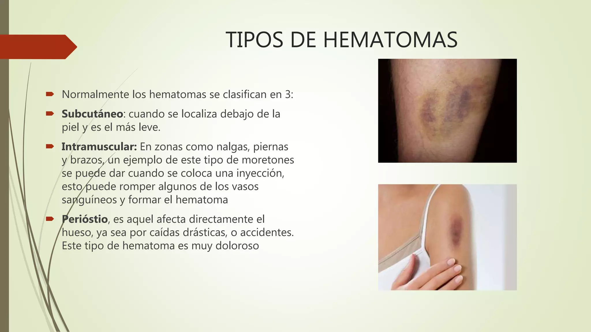 Lesiones traumaticas%2c hematomas y ruptura muscular | PPT