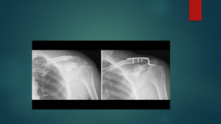 Comprehensive Overview of Traumatic Injuries to the Scapular Girdle and ...