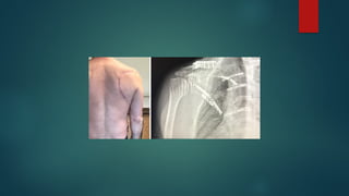 Comprehensive Overview of Traumatic Injuries to the Scapular Girdle and ...