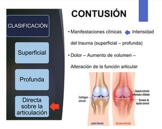 Lesiones traumáticas. Contusión, esguince y luxación | PPTX