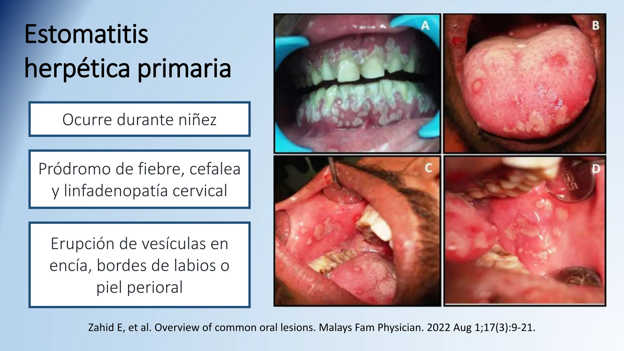 Lesiones Vesiculares y Ulcerativas de la Mucosa Oral | PPTX