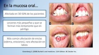 Lesiones Vesiculares y Ulcerativas de la Mucosa Oral | PPTX