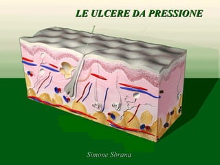 SIMONE SBRANA Lesioni da Pressione | PPT