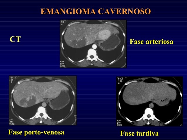 Lesioni focali epatiche (Italian)