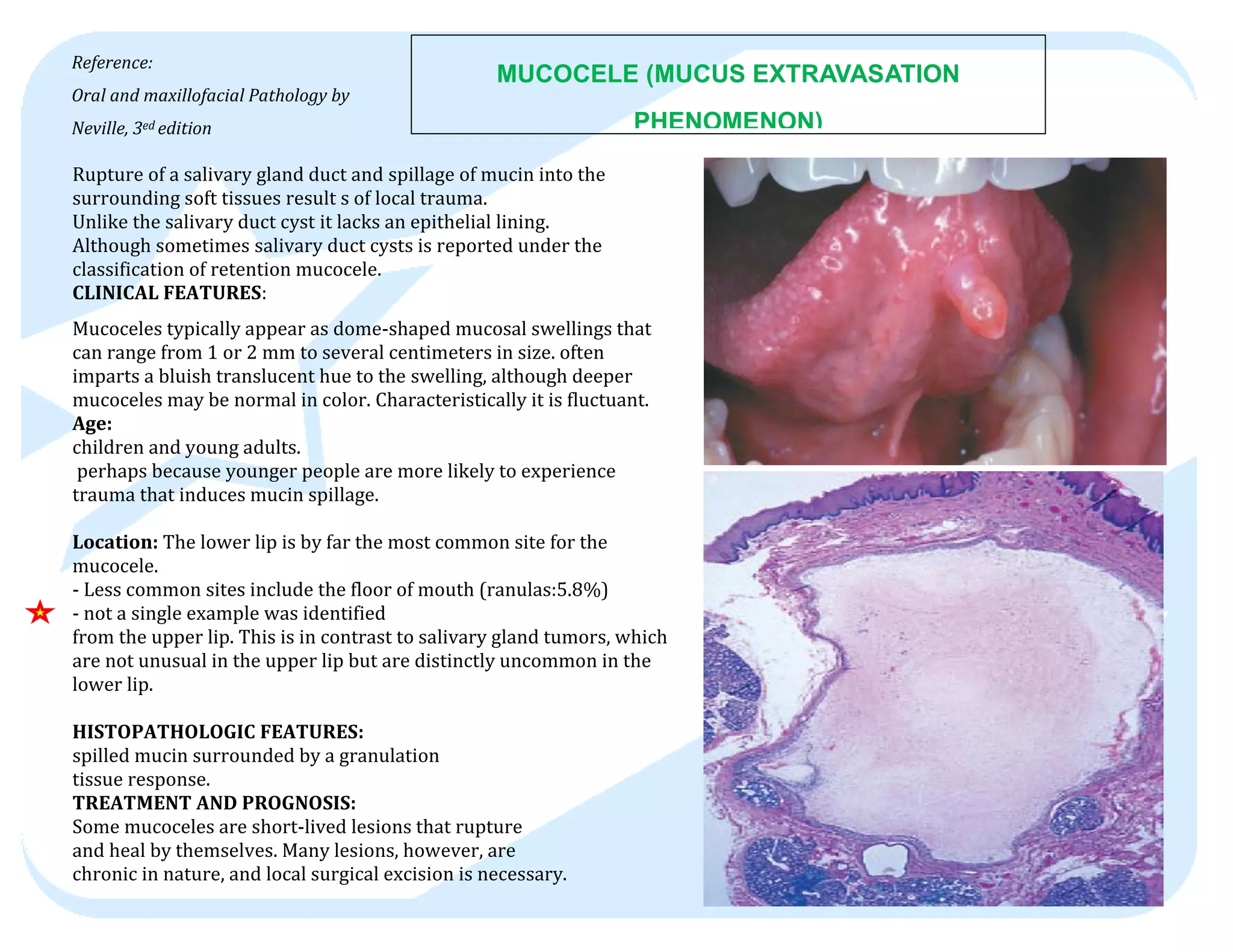 Mucocele extravasation | PDF
