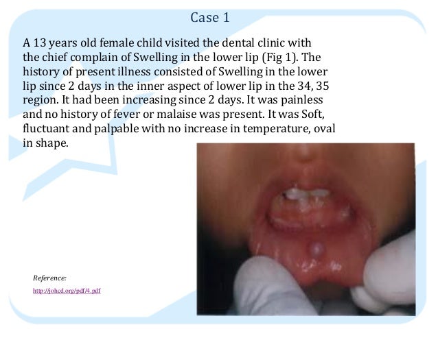 Mucocele extravasation