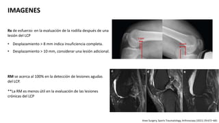 LESION LCP. REVISION DE UN CASO.pptx