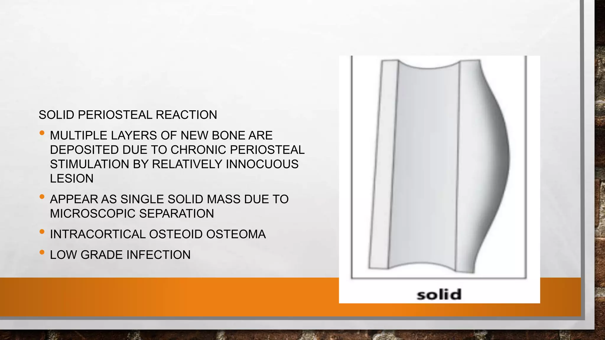 general principle of bone tumour | PPTX