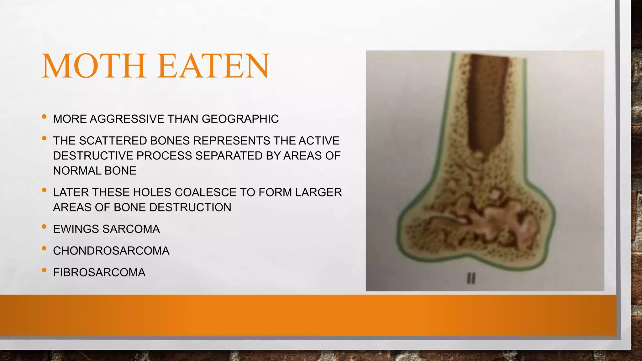 general principle of bone tumour | PPTX