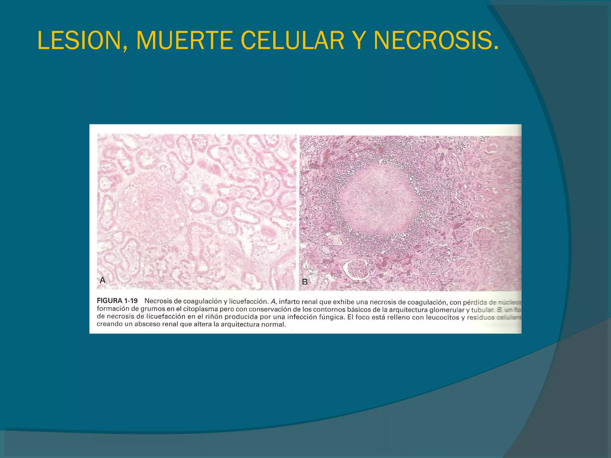 Lesion, muerte celular y necrosis (1) | PPT