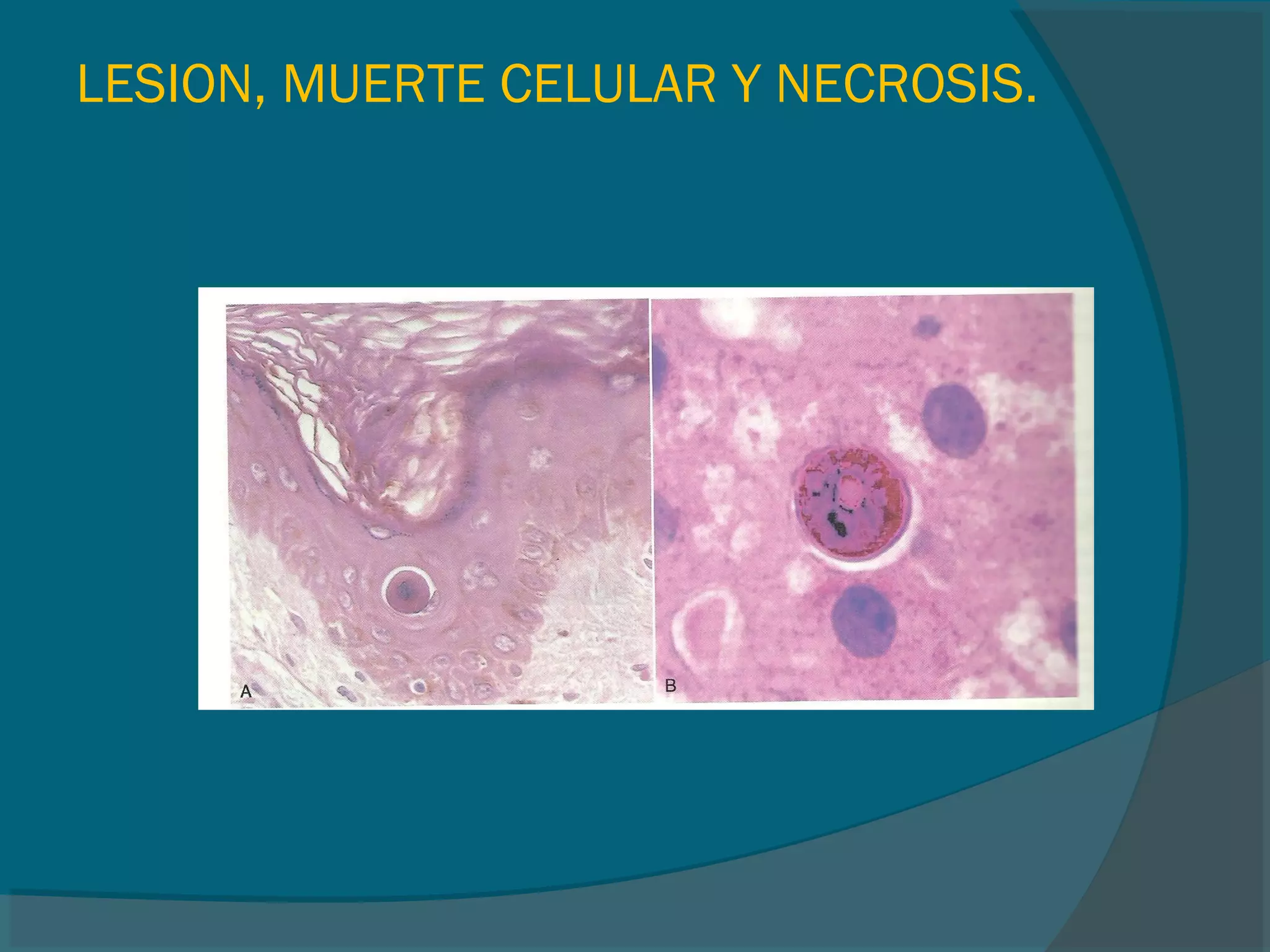 Lesion, muerte celular y necrosis (1) | PPT