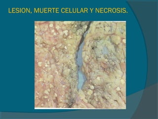 Lesion, muerte celular y necrosis (1) | PPT