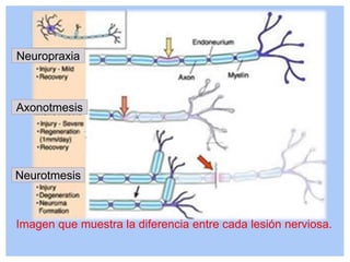 Lesion nerviosa | PPT