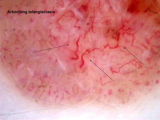 Basal cell carcinoma with unusual dermatoscopic aspects. | PPT | Skin ...