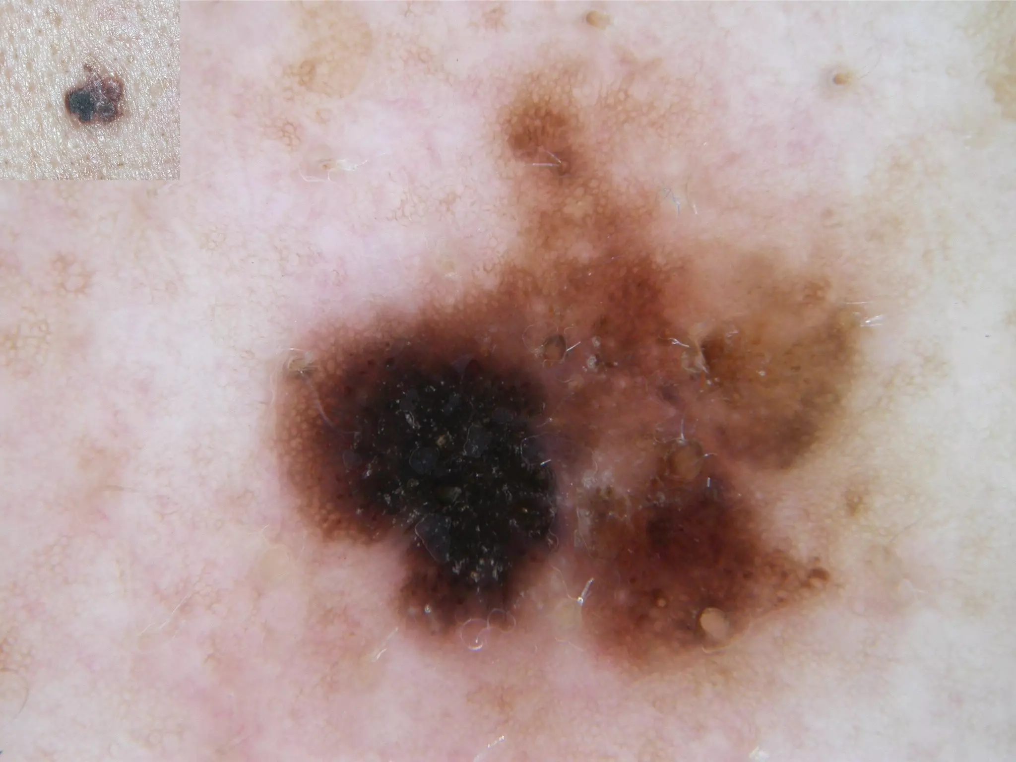 Lesion on the back 2013 | PPT | Skin and Dermatology | Diseases and ...