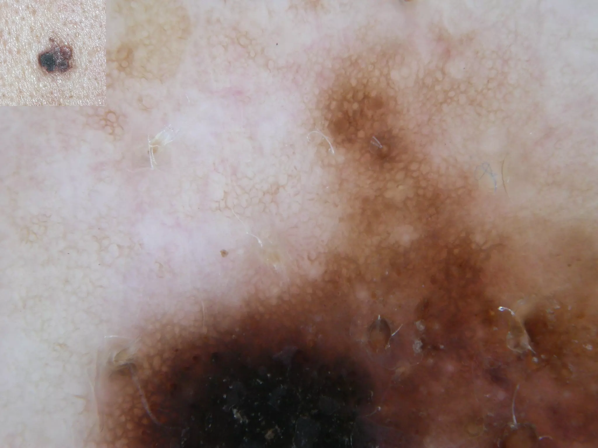 Lesion on the back 2013 | PPT | Skin and Dermatology | Diseases and ...