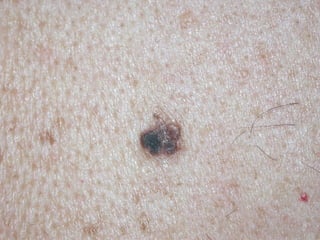 Lesion on the back 2013 | PPT | Skin and Dermatology | Diseases and ...