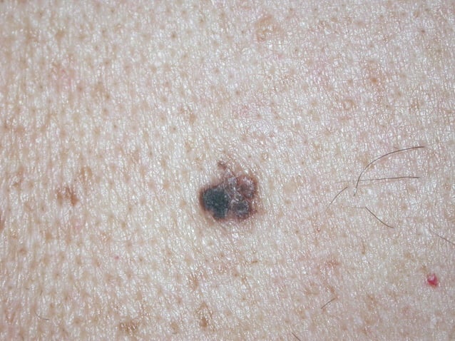 Lesion on the back 2013 | PPT | Skin and Dermatology | Diseases and ...